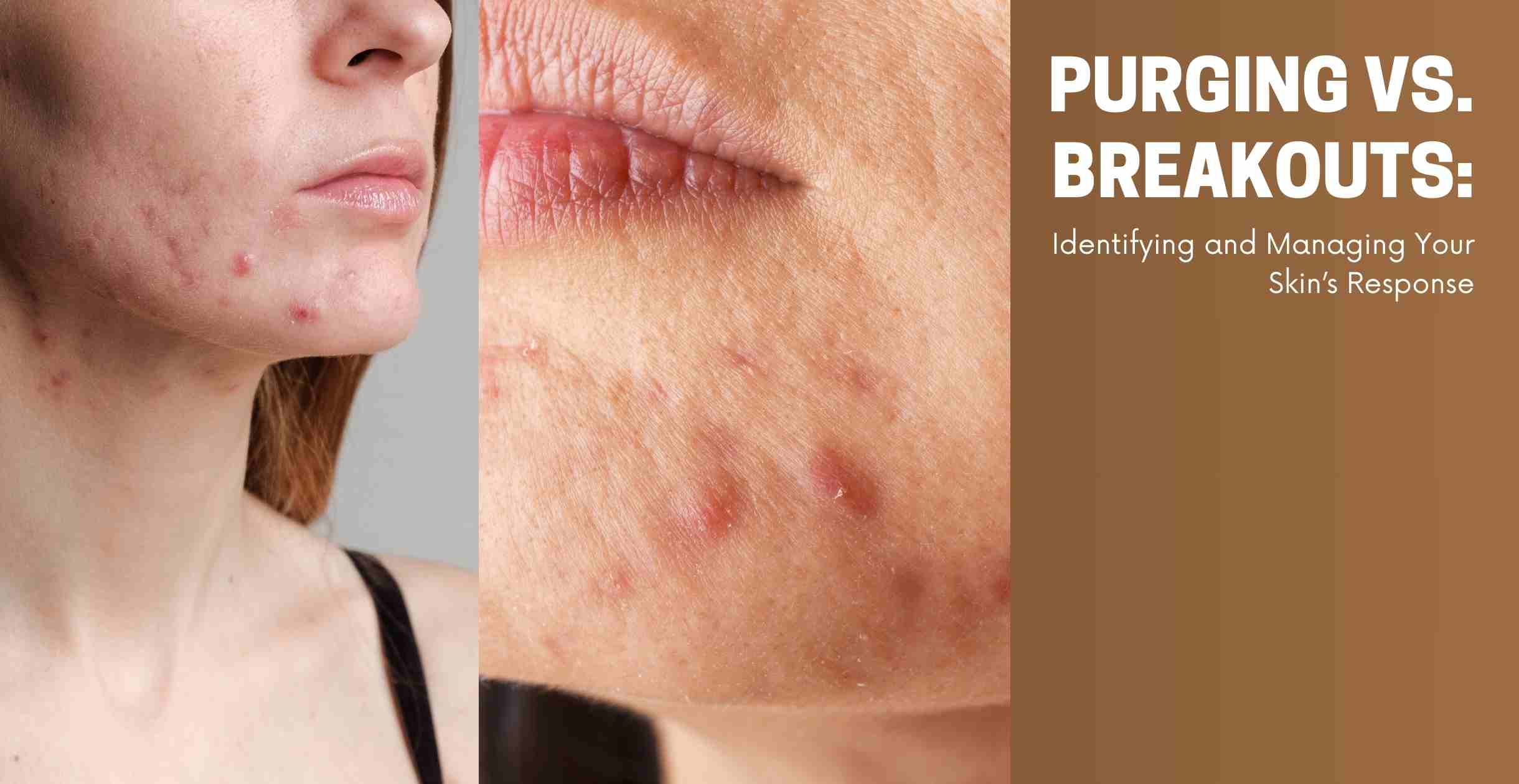 Acne Purging vs Breakout: How to Tell the Difference – ACCEPTANCE